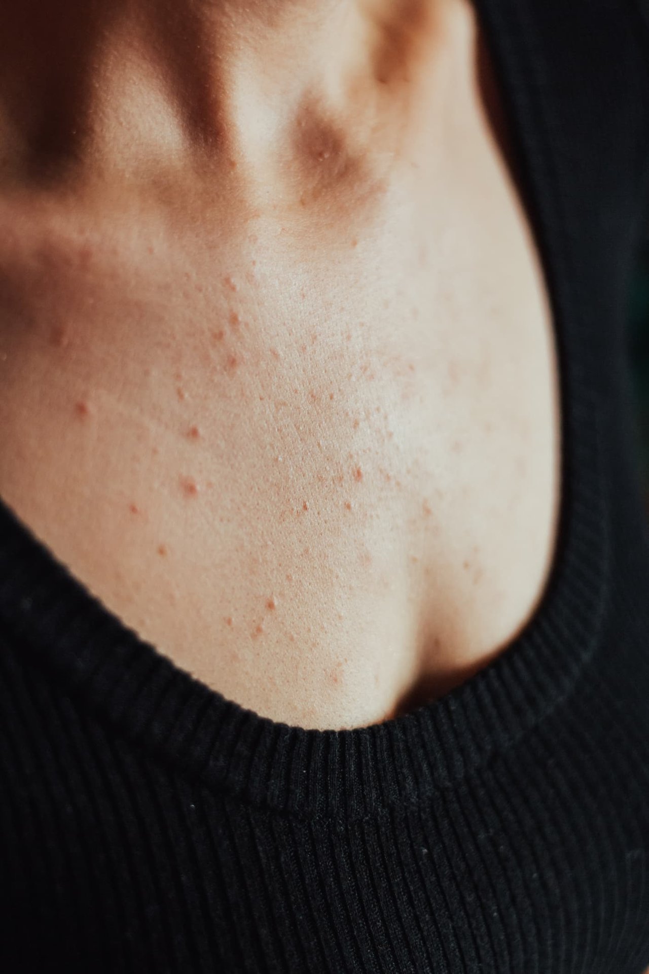 So wirst du Pickel im Dekolleté wieder los | La Roche Posay